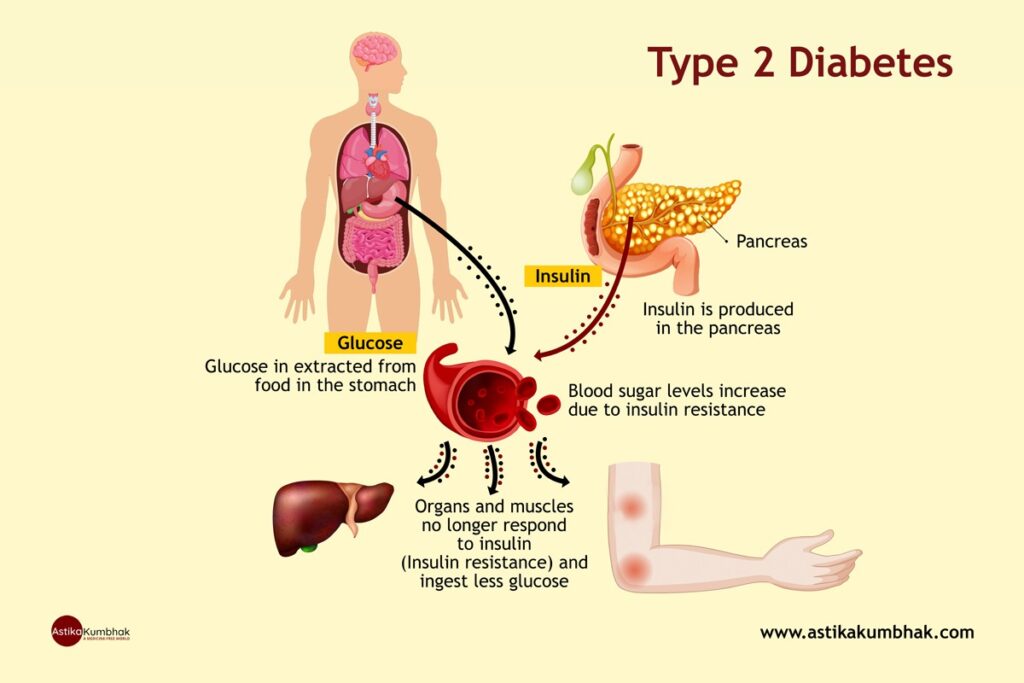 Type 2 Diabetes - My Blog